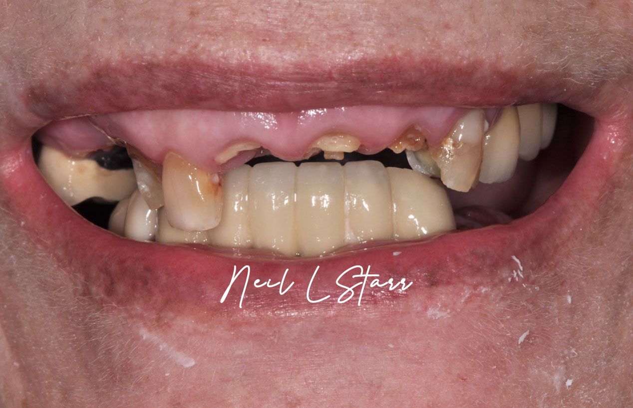 Washington D.C. Teeth in a Day | StarrTeeth Dental