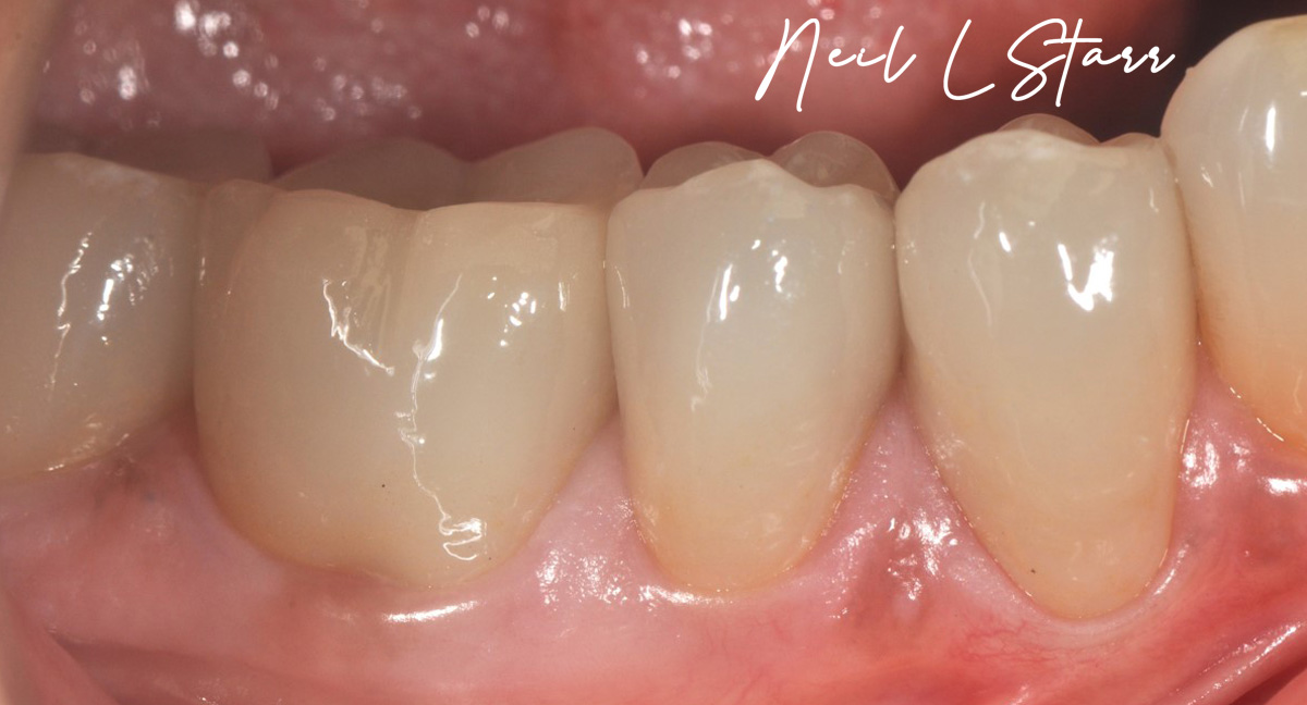 Dental Crowns in Washington D.C. | Starr Teeth Dental