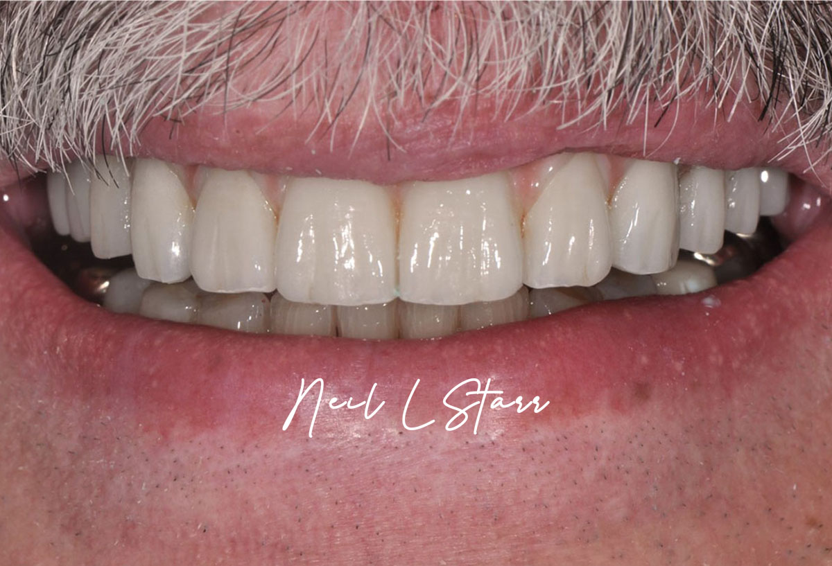 Washington D.C. Teeth in a Day | StarrTeeth Dental