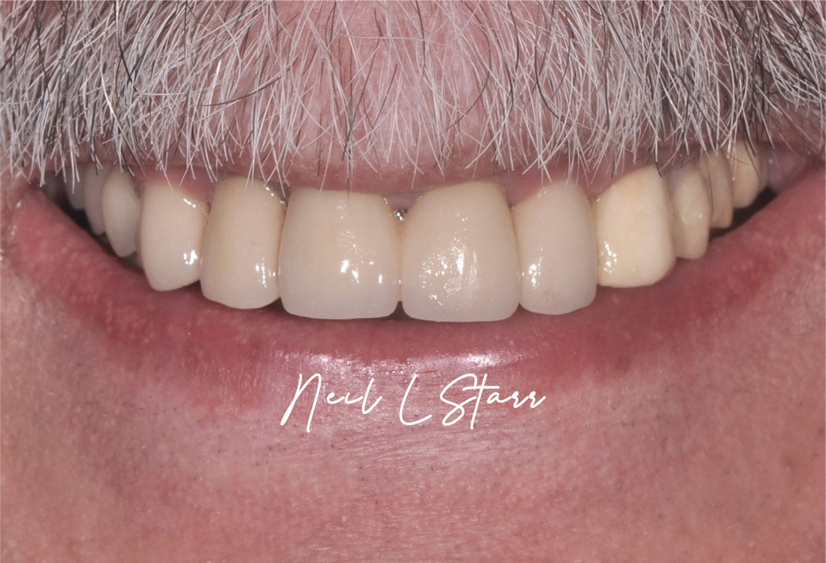 Washington D.C. Teeth in a Day | StarrTeeth Dental