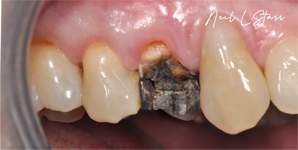 Ceramic Inlays & Onlays in Washington D.C. | StarrTeeth Dental
