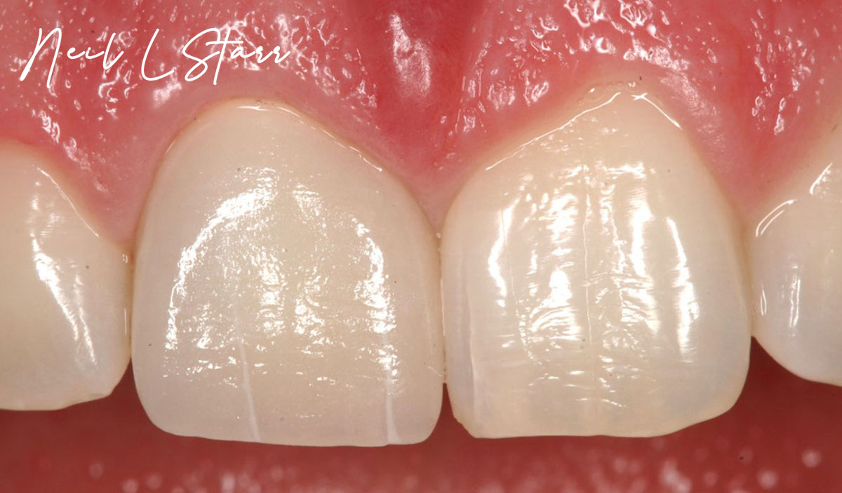 Dental Crowns in Washington D.C. | Starr Teeth Dental
