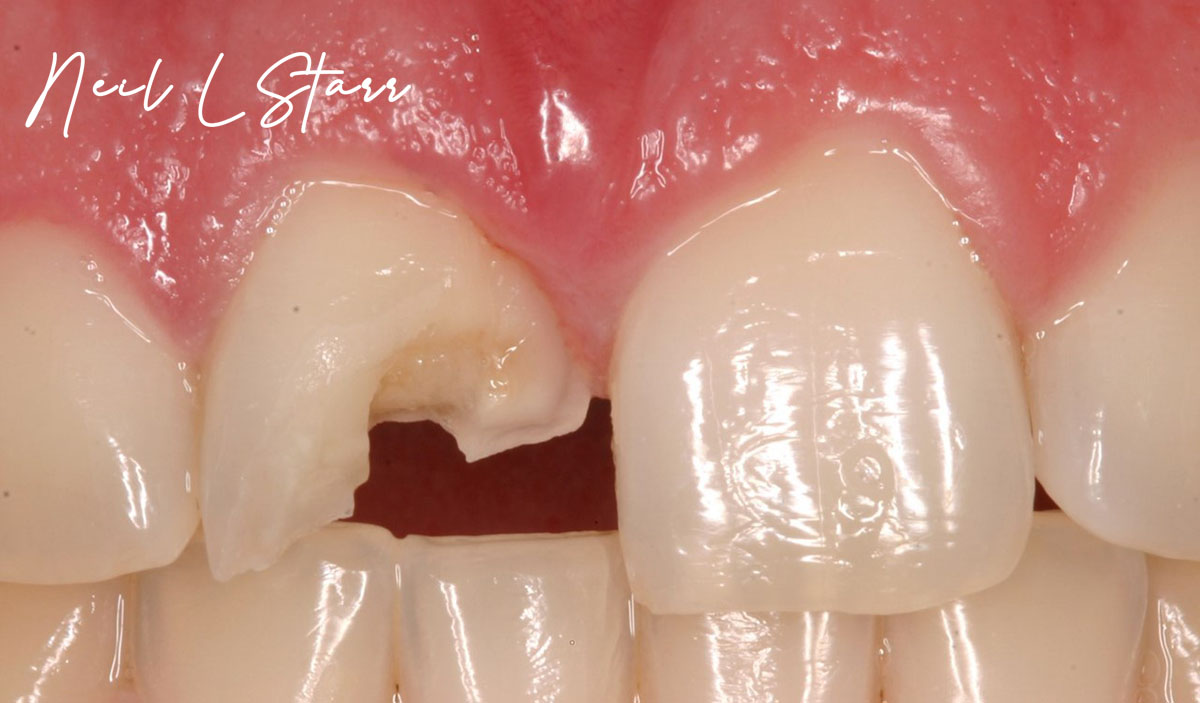 DENTAL CROWNs – Starr Teeth