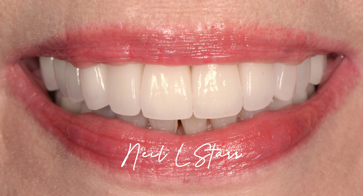 Full Mouth Reconstruction in Washington D.C. | StarrTeeth Dental